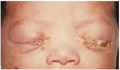 Viral Conjunctivitis Child