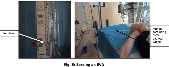 Extra Ventricular Device guideline (EVD)