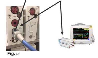 SpO2 monitoring in the highly dependent or critically ill infant or child