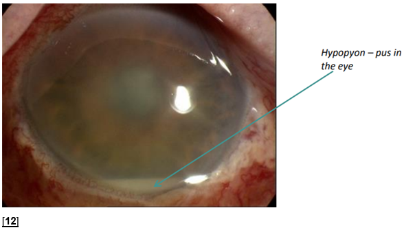 Eye Care in PICU | NHSGGC