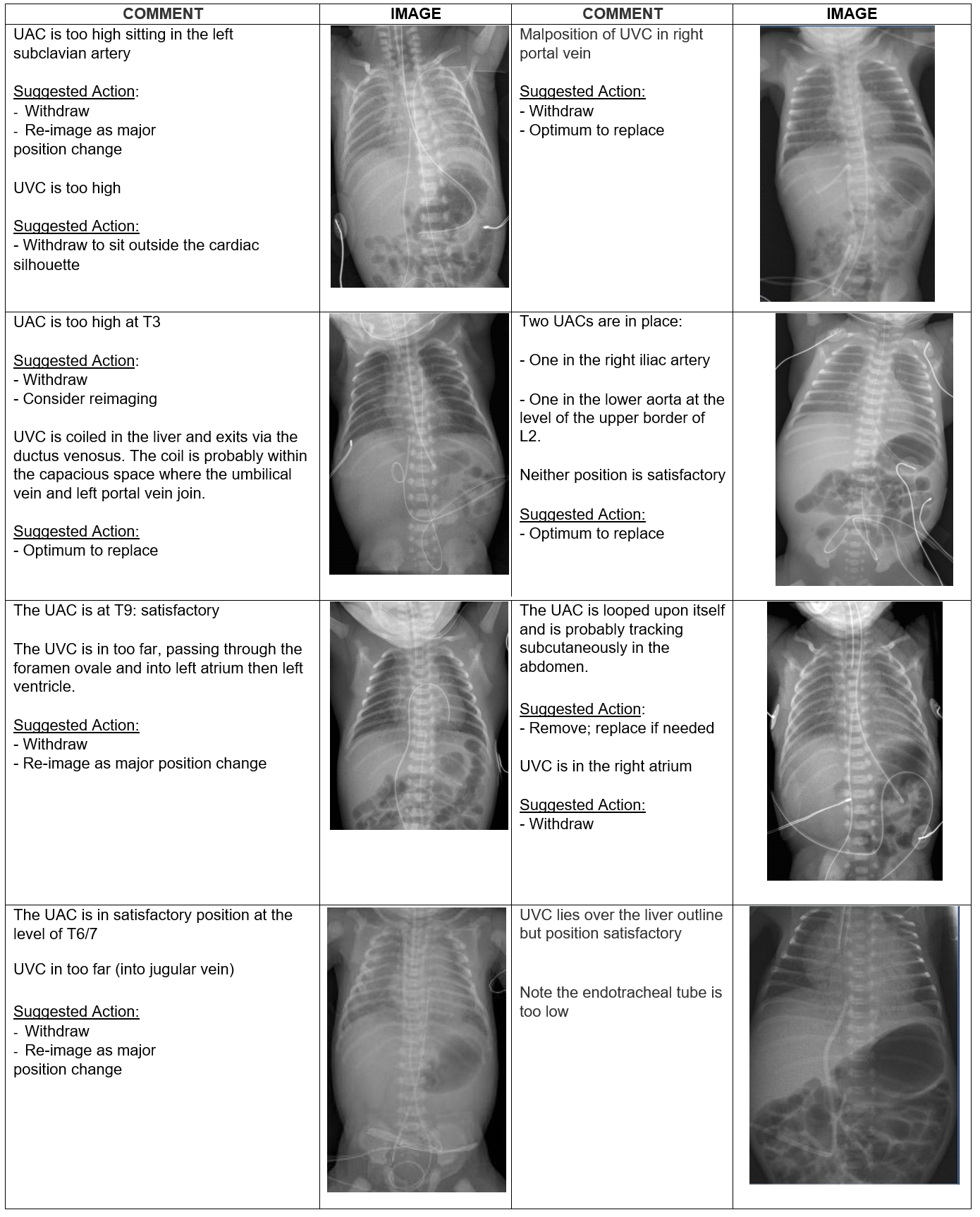 Umbilical catheters | NHSGGC